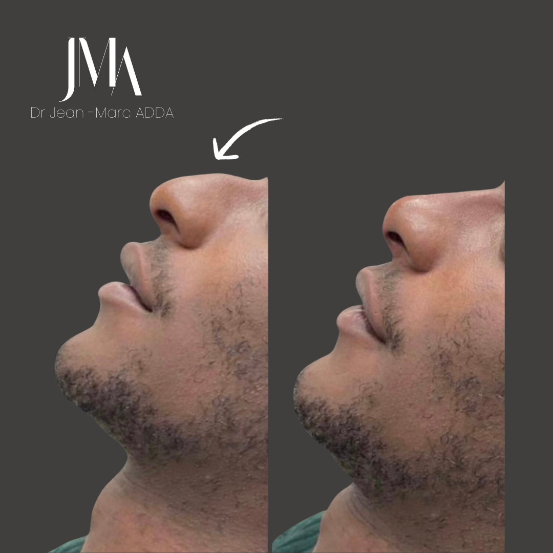 Rhinoplastie médicale
